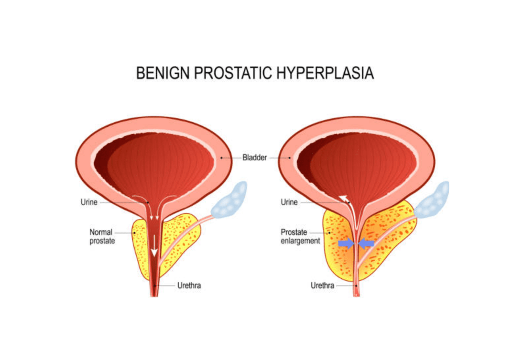 Benign Prostatic Hyperplasia (BPH) - Dr. Daniel Parker